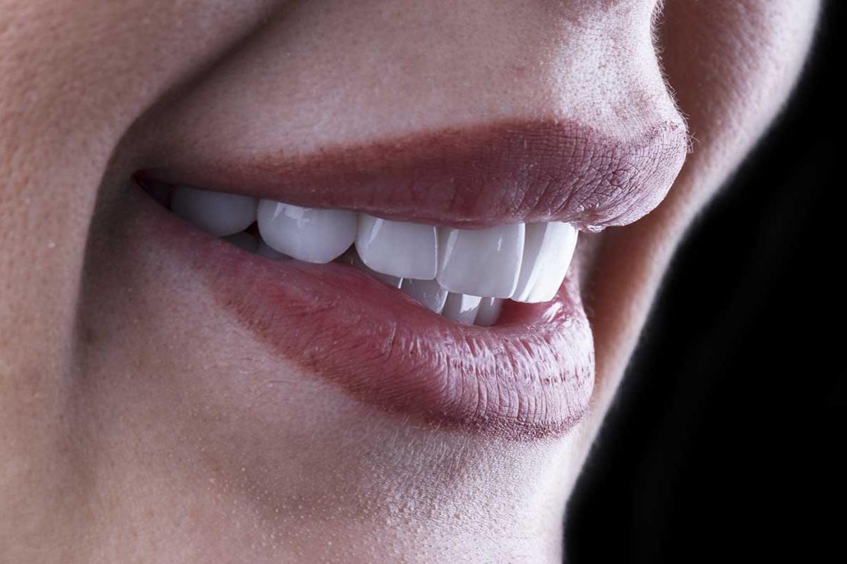 Benefits Of Dental Veneers Cosmetic Dentistry Gulfgate Texas